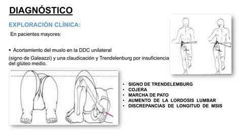 DISPLASIA DEL DESARROLLO DE LA CADERA Pptx