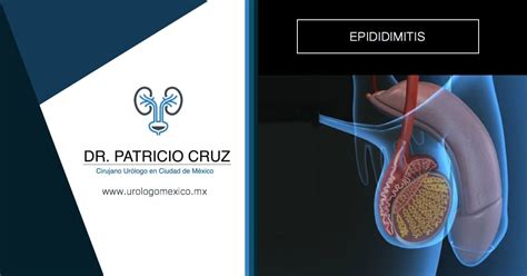 Epididimitis Dr Patricio Cruz Cirujano Ur Logo M Xico