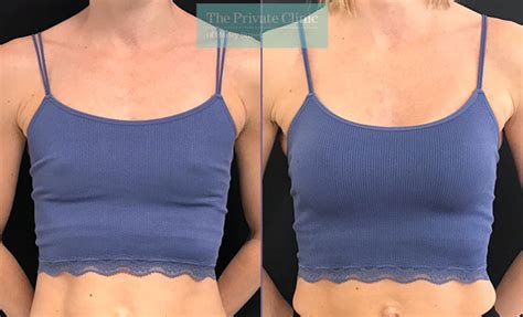 Breast Enlargement 086AR BA The Private Clinic Of Harley Street London