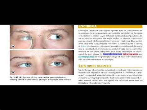Kanski Clinical Ophthalmology Made Easy Strabismus Youtube