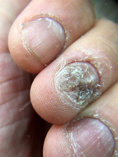 Gran Primer Plano De Infecci N Por Hongos En Las U As De La Mano Dedo