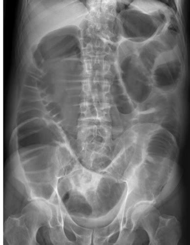 Gi Imaging Flashcards Quizlet