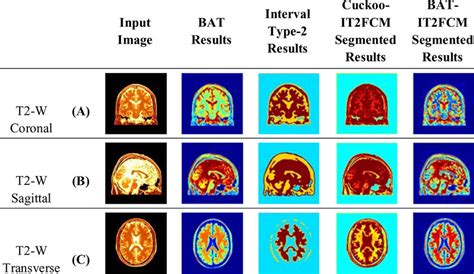 t2 weighted mr brain of 1 noise images segmented by bat it2fcm algorithm download