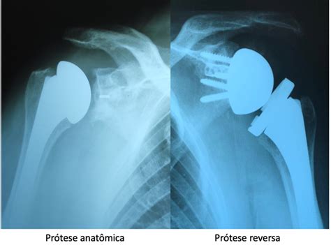 Artrose Do Ombro Dr Artur Utino Membro Do Grupo De Ombro E Cotovelo