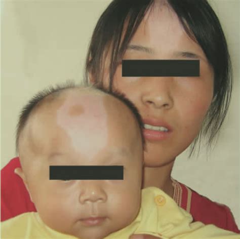 长了白斑就是白癜风这12种疾病同样会导致皮肤变白 MedSci cn