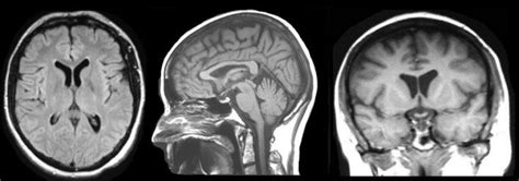 Axial Brain Mri