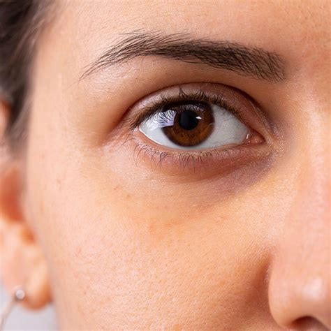Ácido Hialurónico Ojeras Relleno de Ojeras Clínica Alova