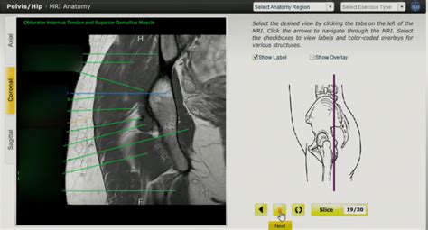 Hip Mri Frontal Plane Slice Diagram Quizlet