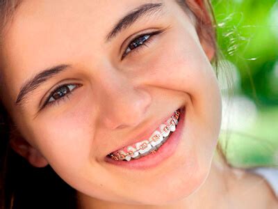Aparelho Dental Est Tico O Clinica Odontol Gica