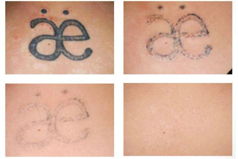 Top 47 Borrado De Tatuajes Abzlocal Mx