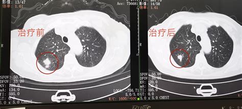 七旬老太出现肺实性结节