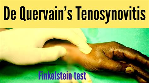 De Quervain S Tenosynovitis Live Surgery St Extensor Compartment