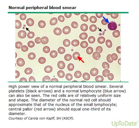 Hematology Evaluation Of Anemia Flashcards Quizlet