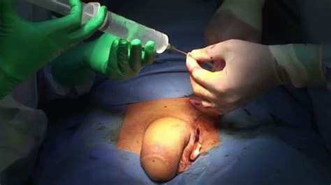 Female To Male Penile Implant Before And After