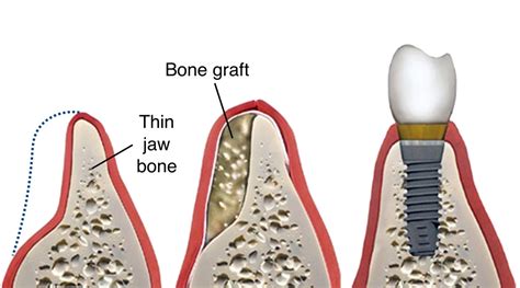 Dental Bone Graft Healing Timeline At Williamajoneso Blog