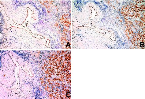 Immunohistochemical Expression Of ER PR And P53 In Lymph Node