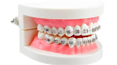 Braquete Soltou Saiba O Que Fazer E Quanto Custa Clinica OralDents