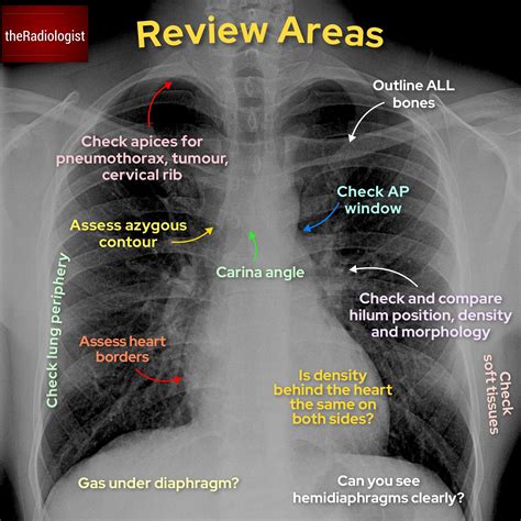 Lateral Chest X Ray Labeled