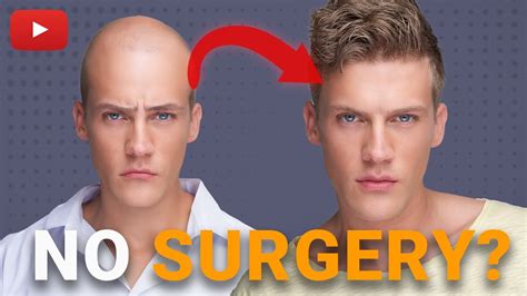 Minoxidil Vs Finasteride Battle Of The Hair Loss Treatments YouTube
