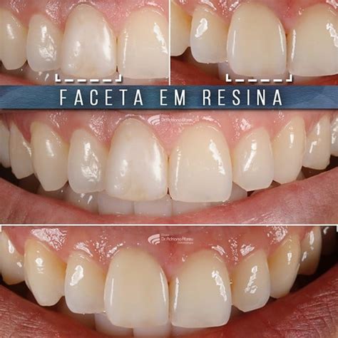 Facetas de Resina O que são e qual sua indicação Estética 1