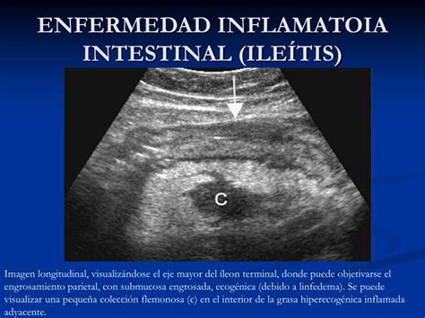 Ppt Hallazgos Ecogr Ficos De La Apendicitis Aguda Y Sus Principales