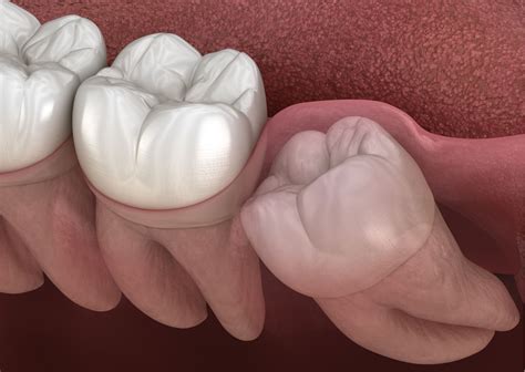 A qué edad salen las muelas del juicio Clínica Dental Everest