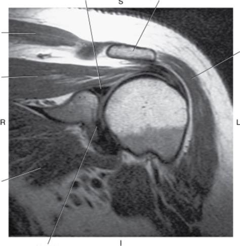 Mri Coronal Lt Shoulder Diagram Quizlet