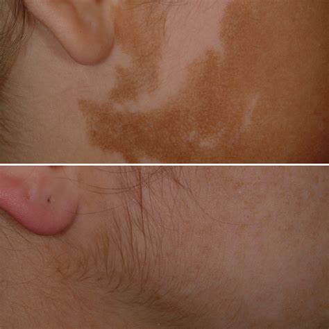 Birthmark Laser Treatment Physicians Laser And Dermatology Institute