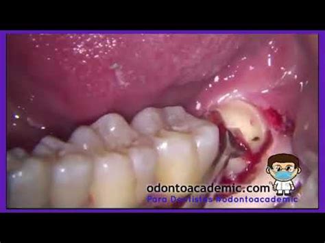 Como Se Ve Una Muela Del Juicio Infectada Técnico dental