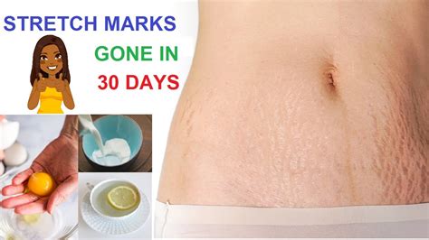 Natural Home Remedy For Stretch Marks After Pregnancy Types And Causes