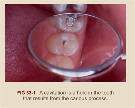 Chapter 33 Interpretation Of Dental Caries Flashcards Quizlet