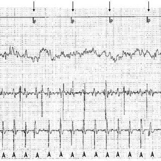 Immediate PM Interrogation Result With Monomorphic Ventricular