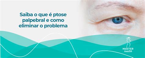 Ptose palpebral o que é e como corrigir Blog Master Health