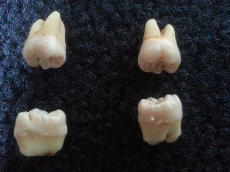 Cette Tude Explique Pourquoi Les Dents De Sagesse Ne Poussent Qu L