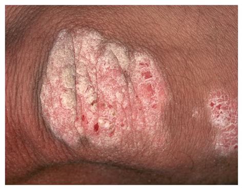 Psoriasis Symptoms PsoriasisSPEAKS