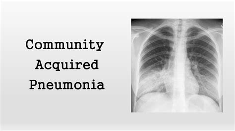 Community Acquired Pneumonia YouTube