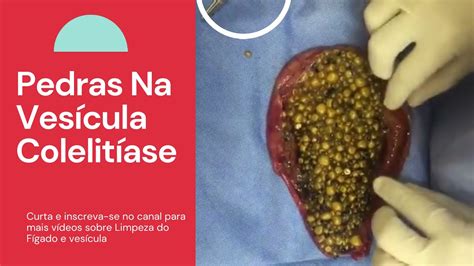 PEDRAS NA VESÍCULA I CIRURGIA É A ÚNICA OPÇÃO YouTube