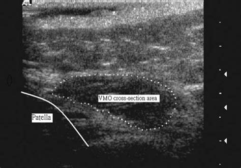 The Measurement Of The Vastus Medialis Obliquus VMO Cross Section
