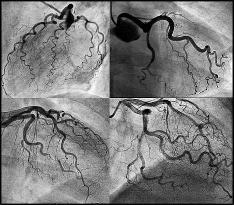Spontaneous Coronary Artery Dissection Contemporary Aspects Of