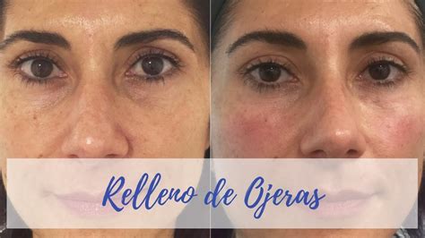 RELLENO de OJERAS con ÁCIDO HIALURÓNICO Antes y Después YouTube