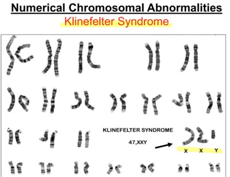 Numerical Chromosomal Abnormalities Flashcards Quizlet