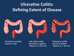 Ulcerative Colitis Different Types Causes And Associated Symptoms