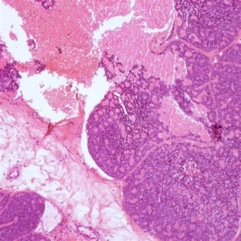 Hematoxylin And Eosin HE Staining Of The Biopsy Specimen Low Power