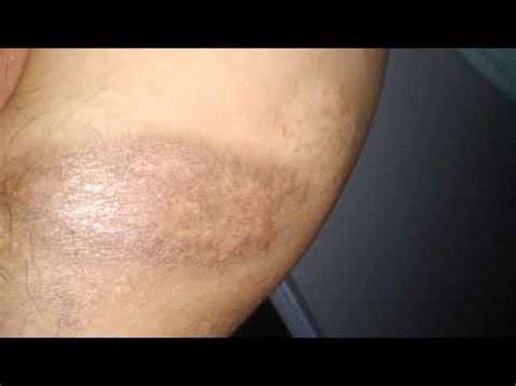 Cicatriz De Quemadura Con Escape De Moto YouTube