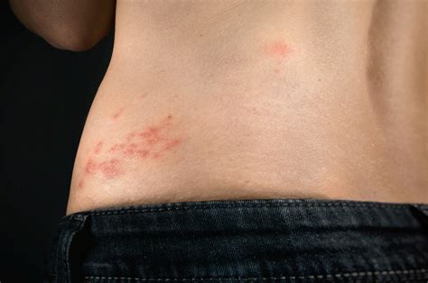 G Rtelrose Symptome Ursachen Behandlung Von Herpes Zoster