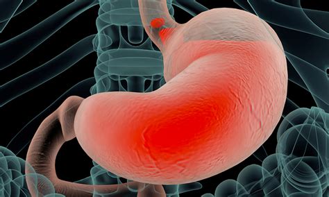 Aspectos Endoscópicos da Doença do Refluxo Gastroesofágico DRGE FBG