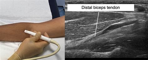 Distal Biceps Tendon Pain Musculoskeletal Ultrasound Injections