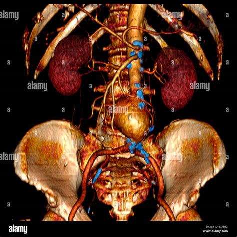 D Abdominal Angiographic Ct Scan Abdominal Aortic Aneurysm Stock