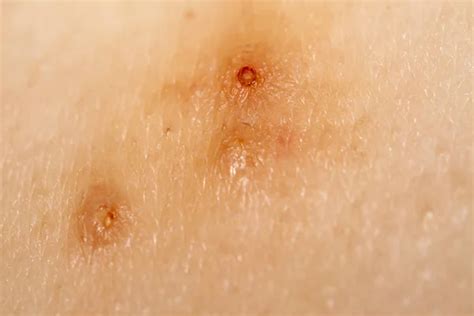Close Up Of Molluscum Contagiosum Also Called Water Wart Stock Photo