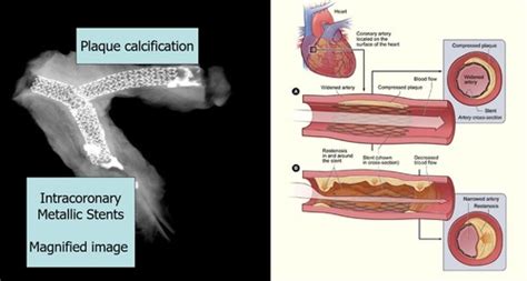 ACS Acute Coronary Syndrome Flashcards Quizlet